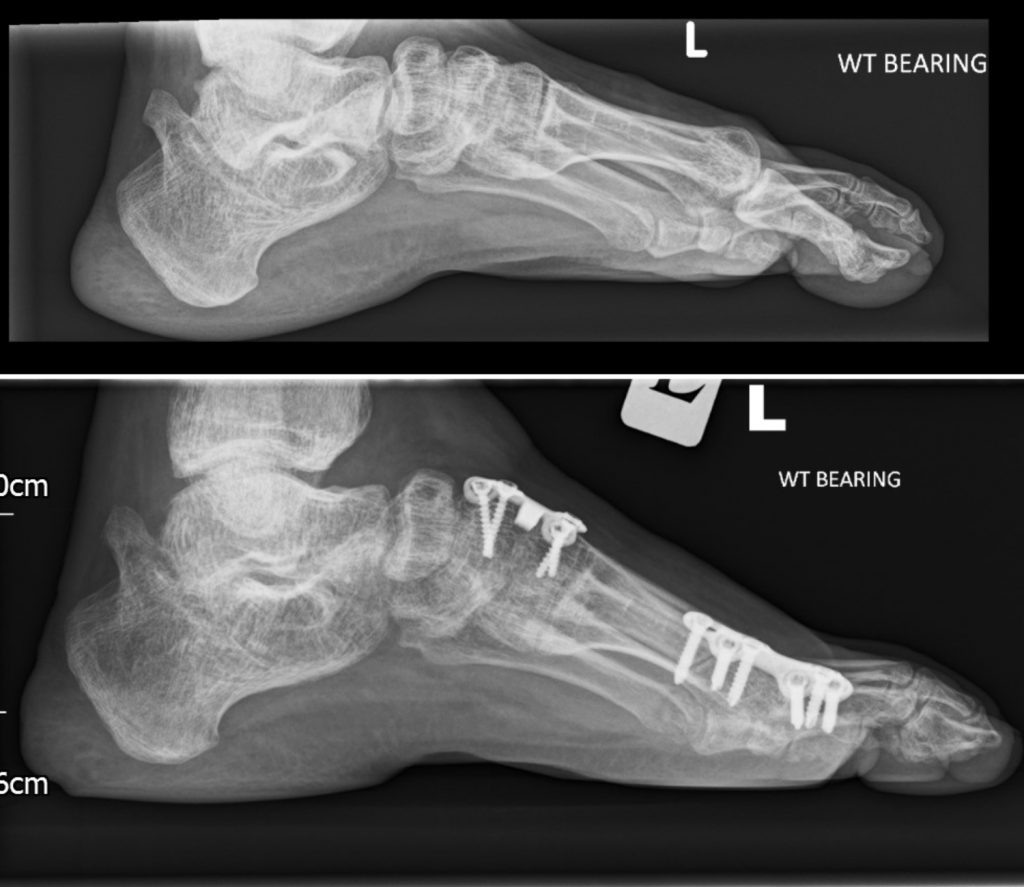 Crossover Toes - Nick Savva Consulting