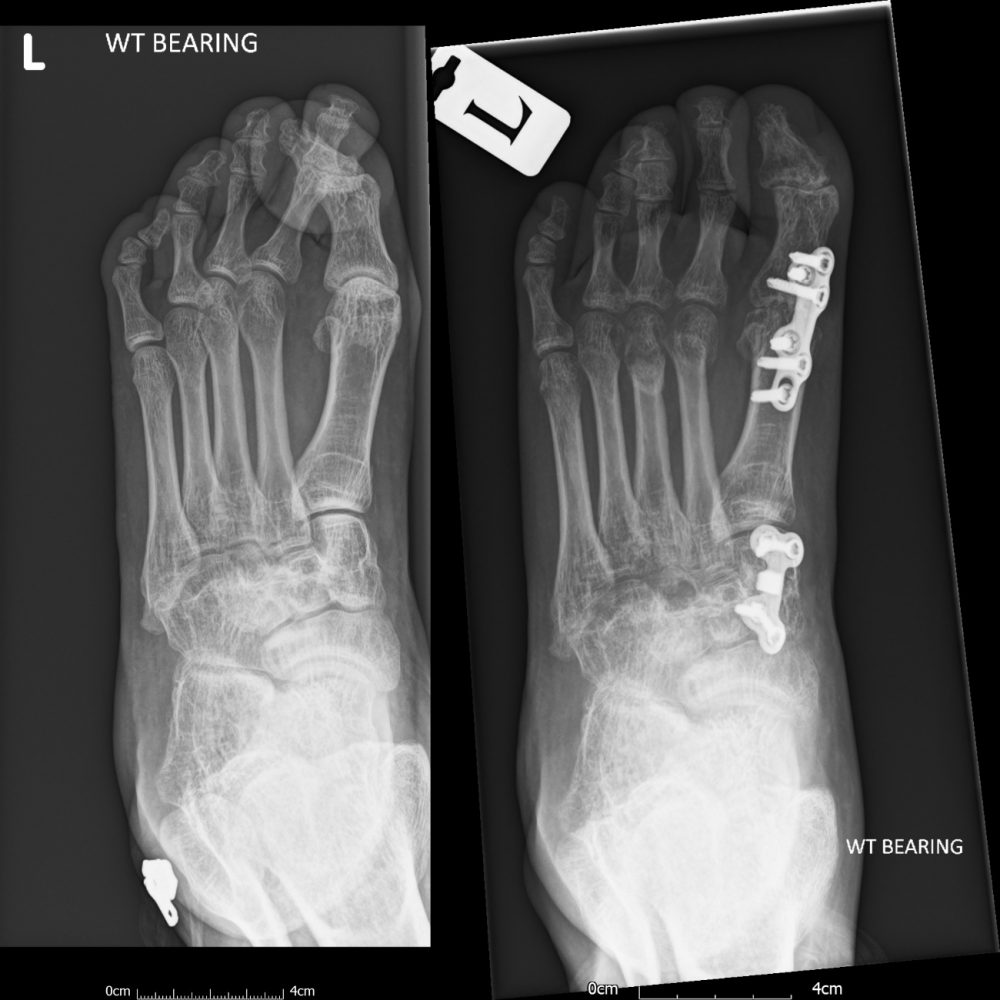 Crossover Toes - Nick Savva Consulting